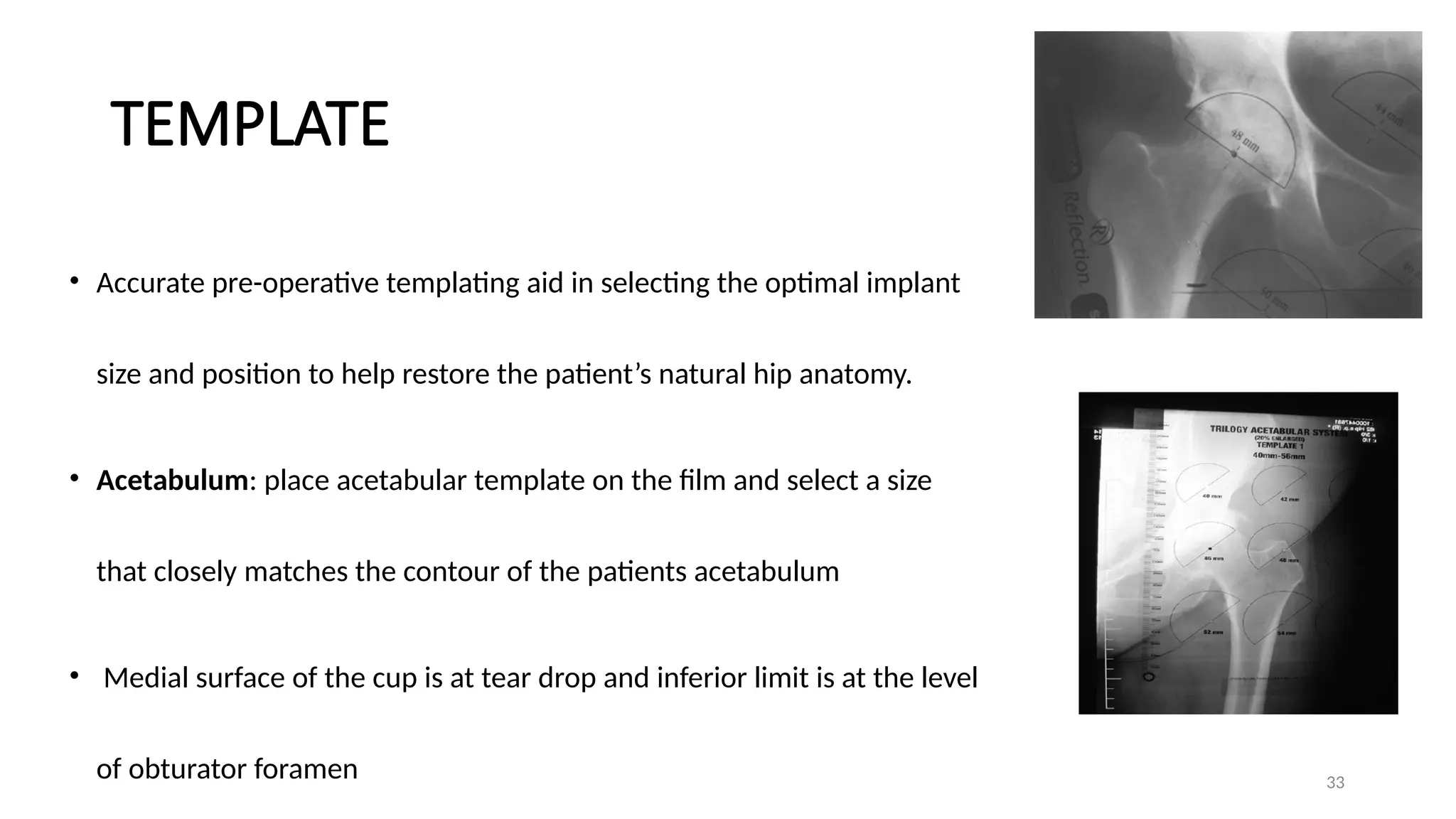 An brief summary about tota hip arthroplasty | PPTX