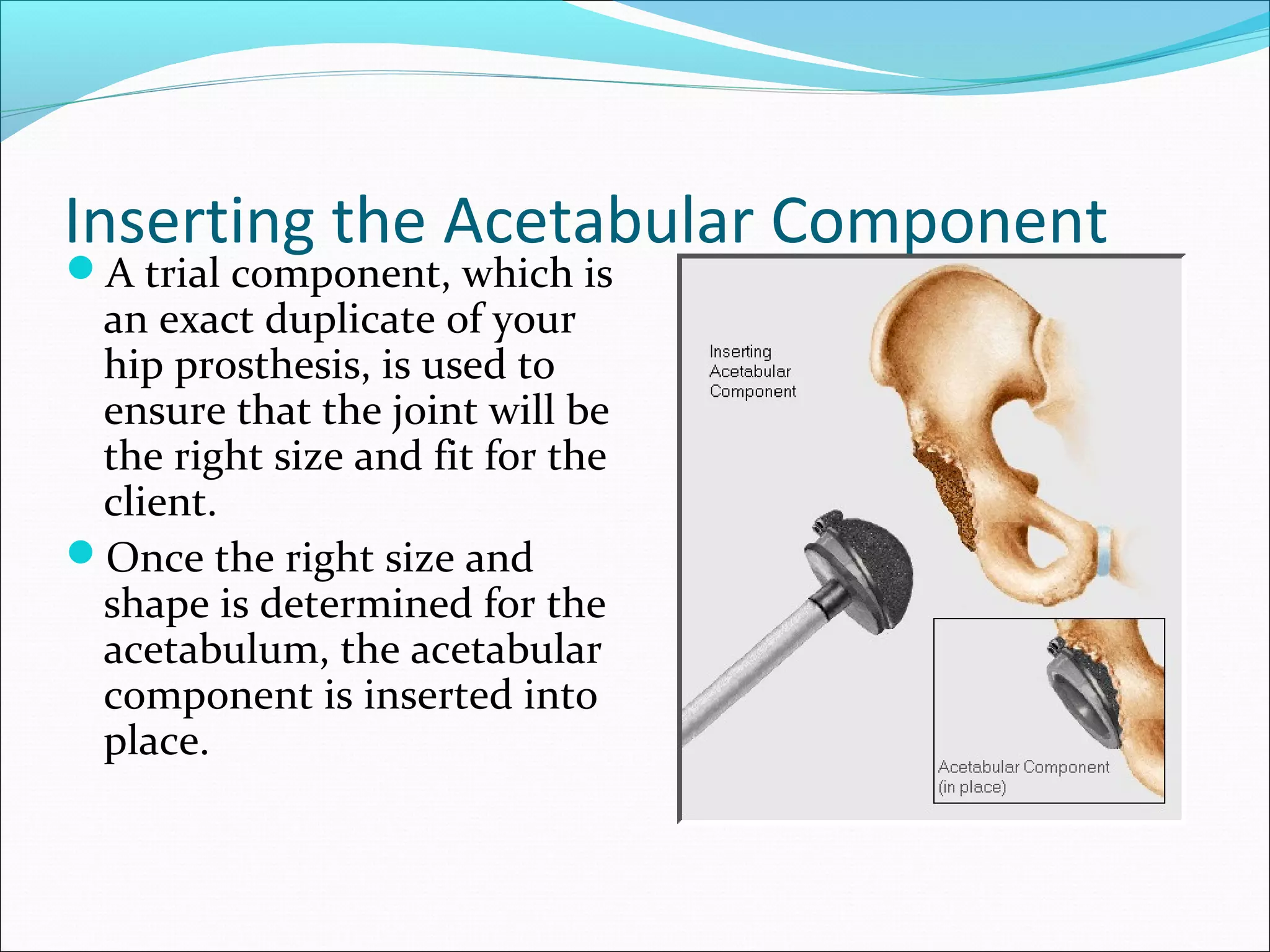 total hip replacement discussion | PPT
