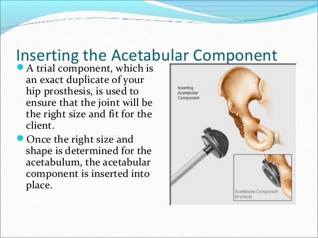 total hip replacement discussion