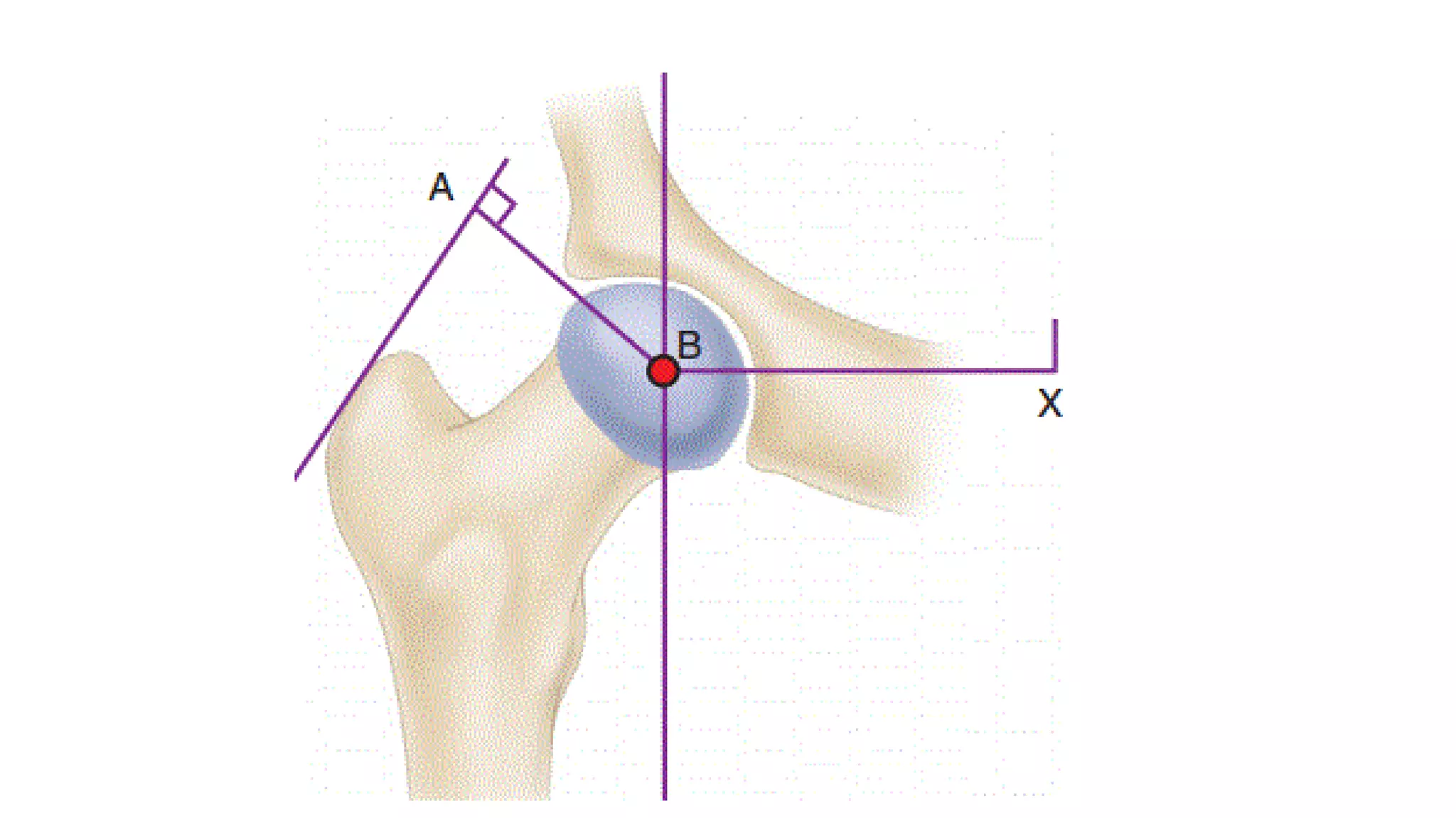 Total hip arthroplasty, dislocation | PDF