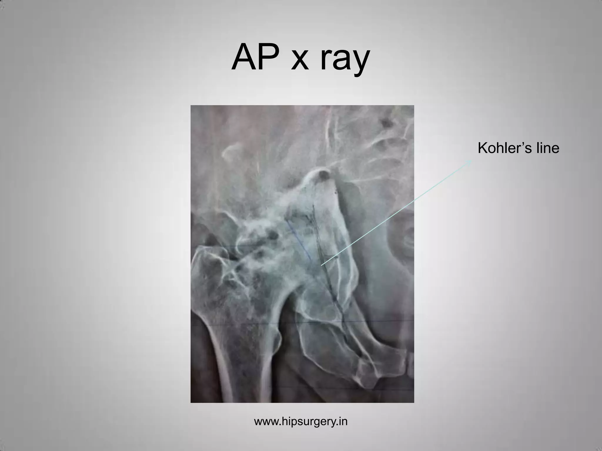 Total hip replacement in protrusio acetabuli | PPTX