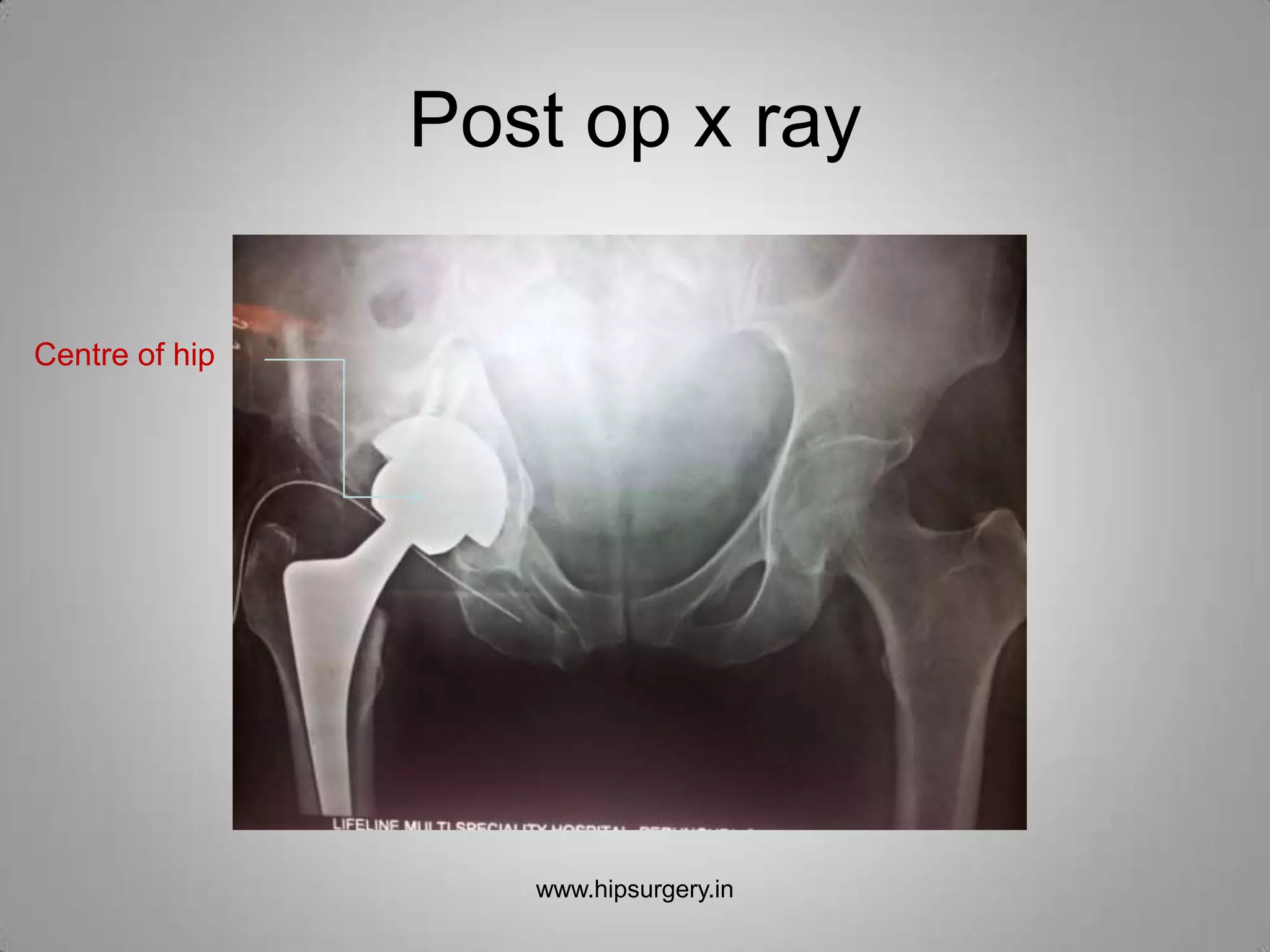Total hip replacement in protrusio acetabuli | PPTX