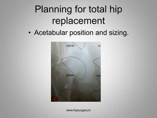 Total hip replacement in protrusio acetabuli | PPTX