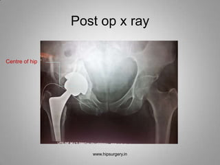 Total hip replacement in protrusio acetabuli | PPTX