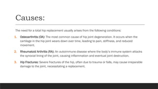 Total Hip Replacement or Hip Arthroplasty PT Management ...