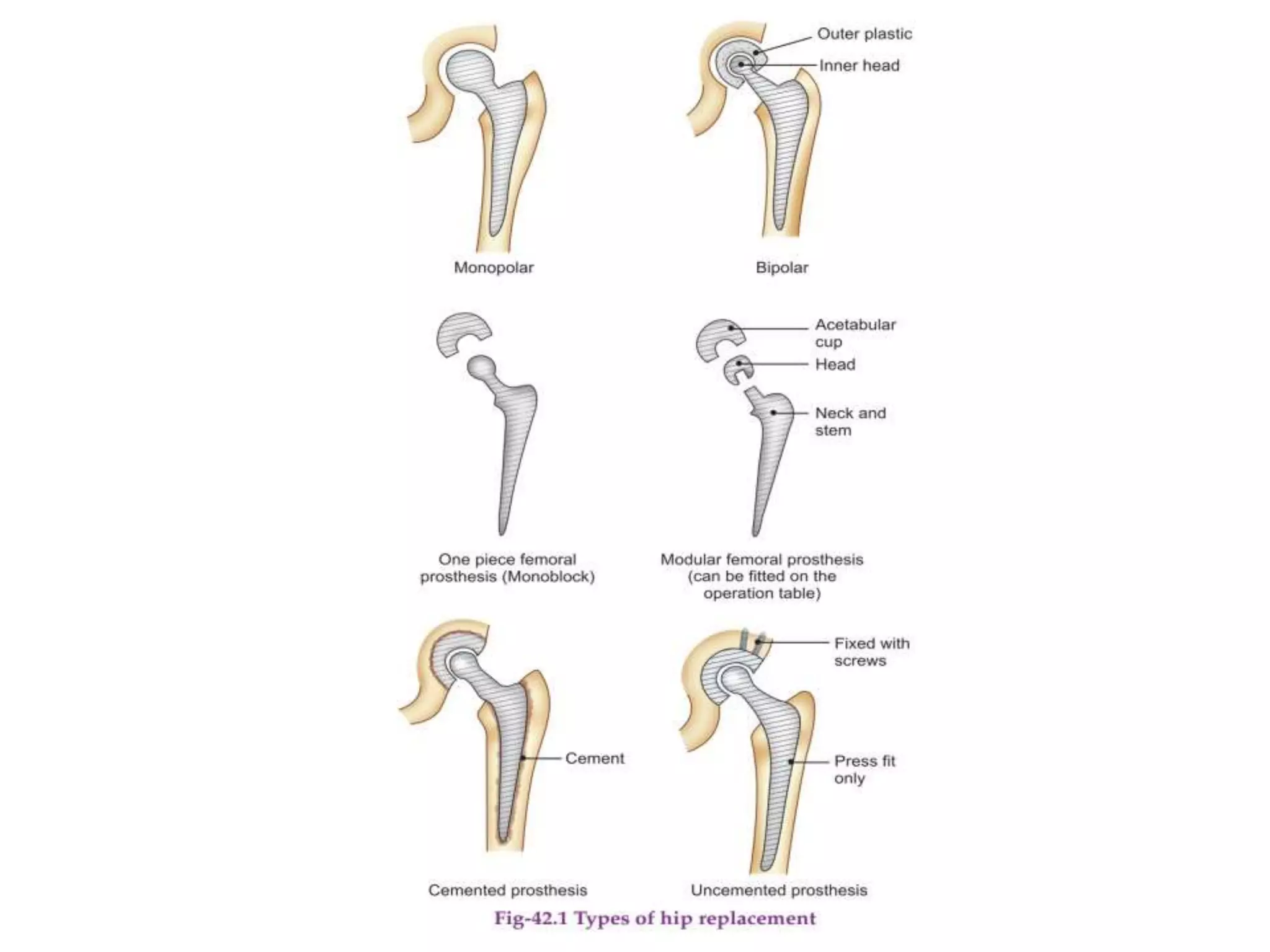 Total joint replacement, Dr Arun C Raj, Ortho Resident KIMS, Hubli | PPT