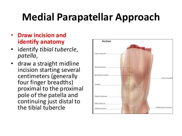 Total knee approaches