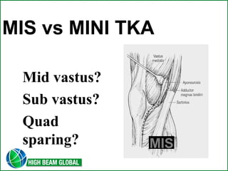 Total knee arthroplasty | PPT