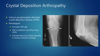 Total Knee Arthroplasty | Knee Replacement | South Windsor, Rocky Hill ...