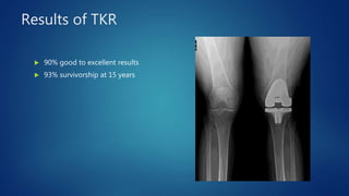 Total Knee Arthroplasty | Knee Replacement | South Windsor, Rocky Hill ...