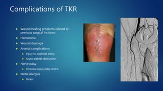 Total Knee Arthroplasty | Knee Replacement | South Windsor, Rocky Hill ...