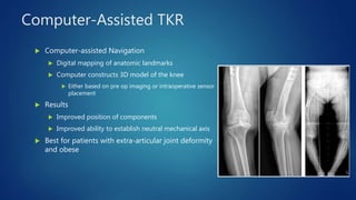 Total Knee Arthroplasty | Knee Replacement | South Windsor, Rocky Hill ...