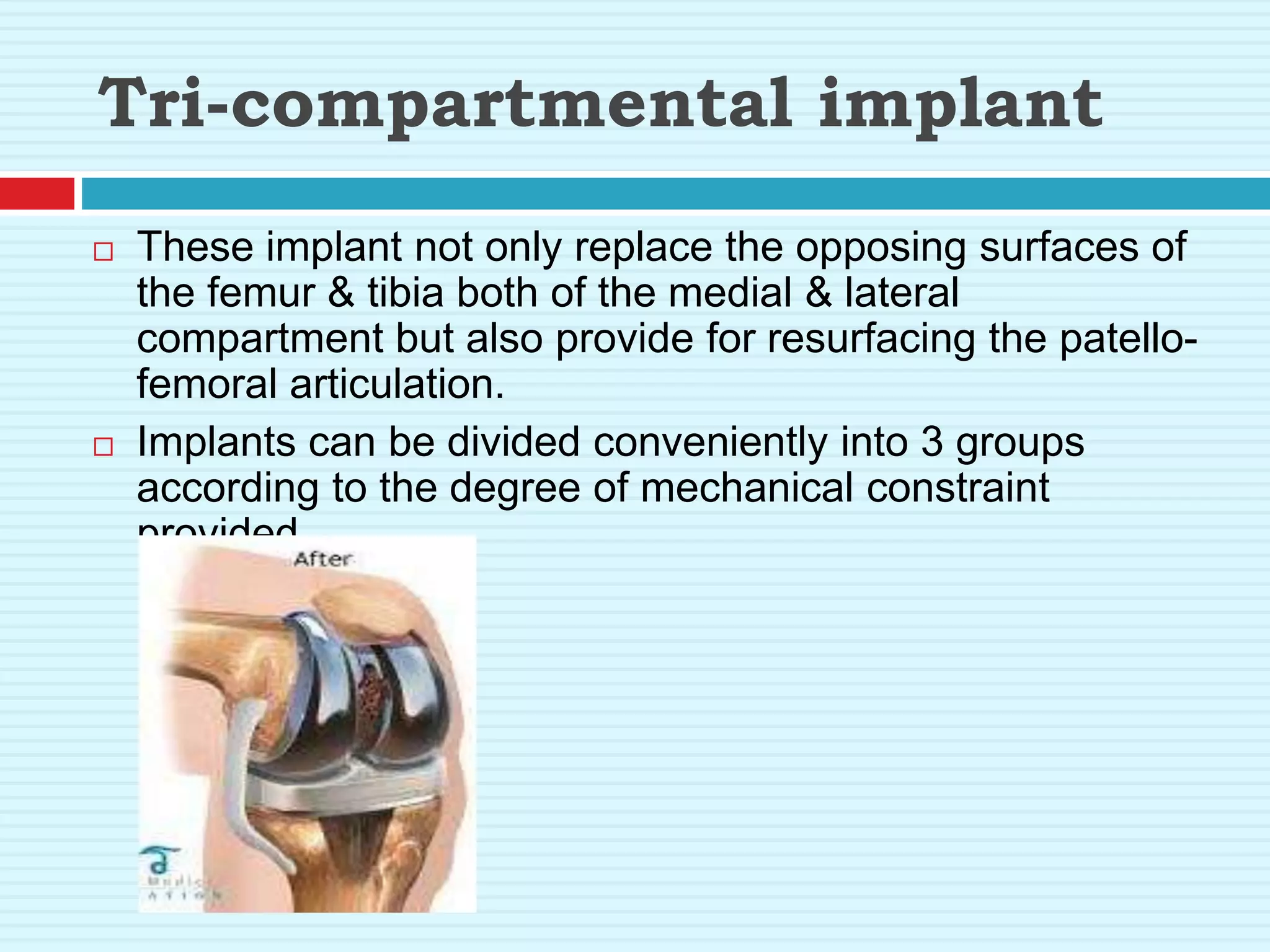 Total knee arthroplasty.pptx