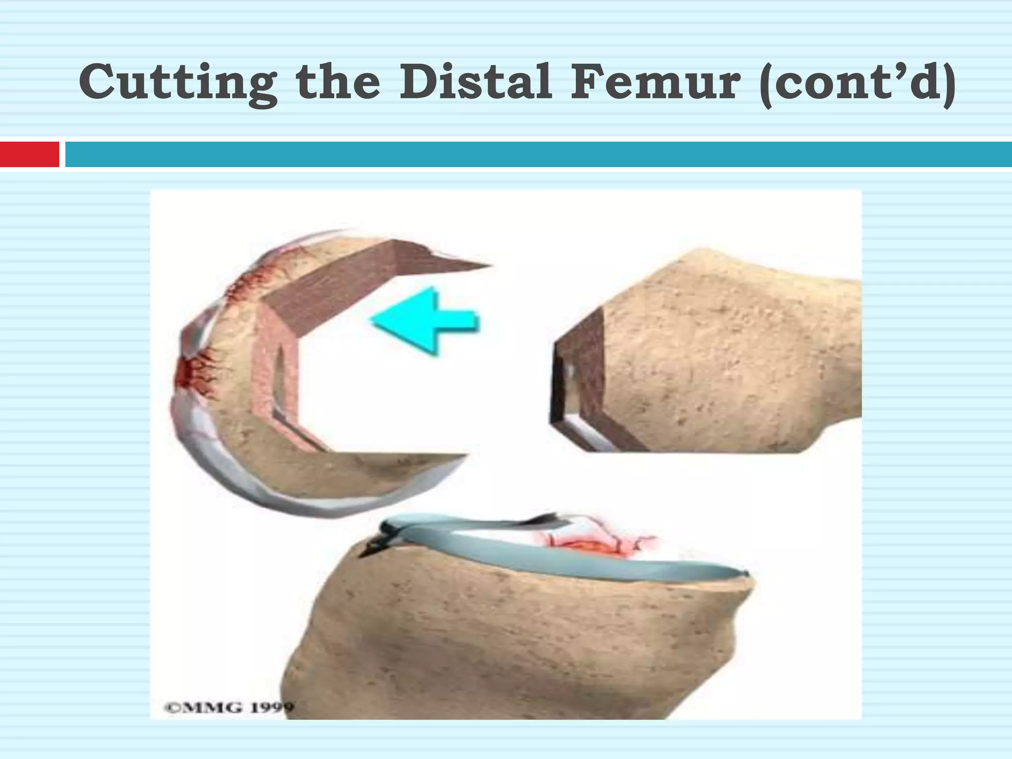 Total knee arthroplasty.pptx