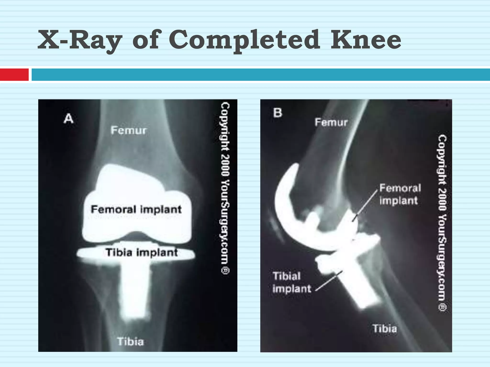 Total knee arthroplasty.pptx