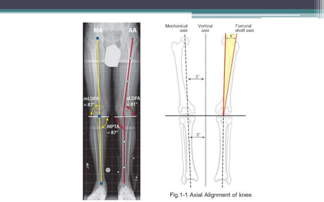 Total Knee Arthroplasty Principle | PPTX