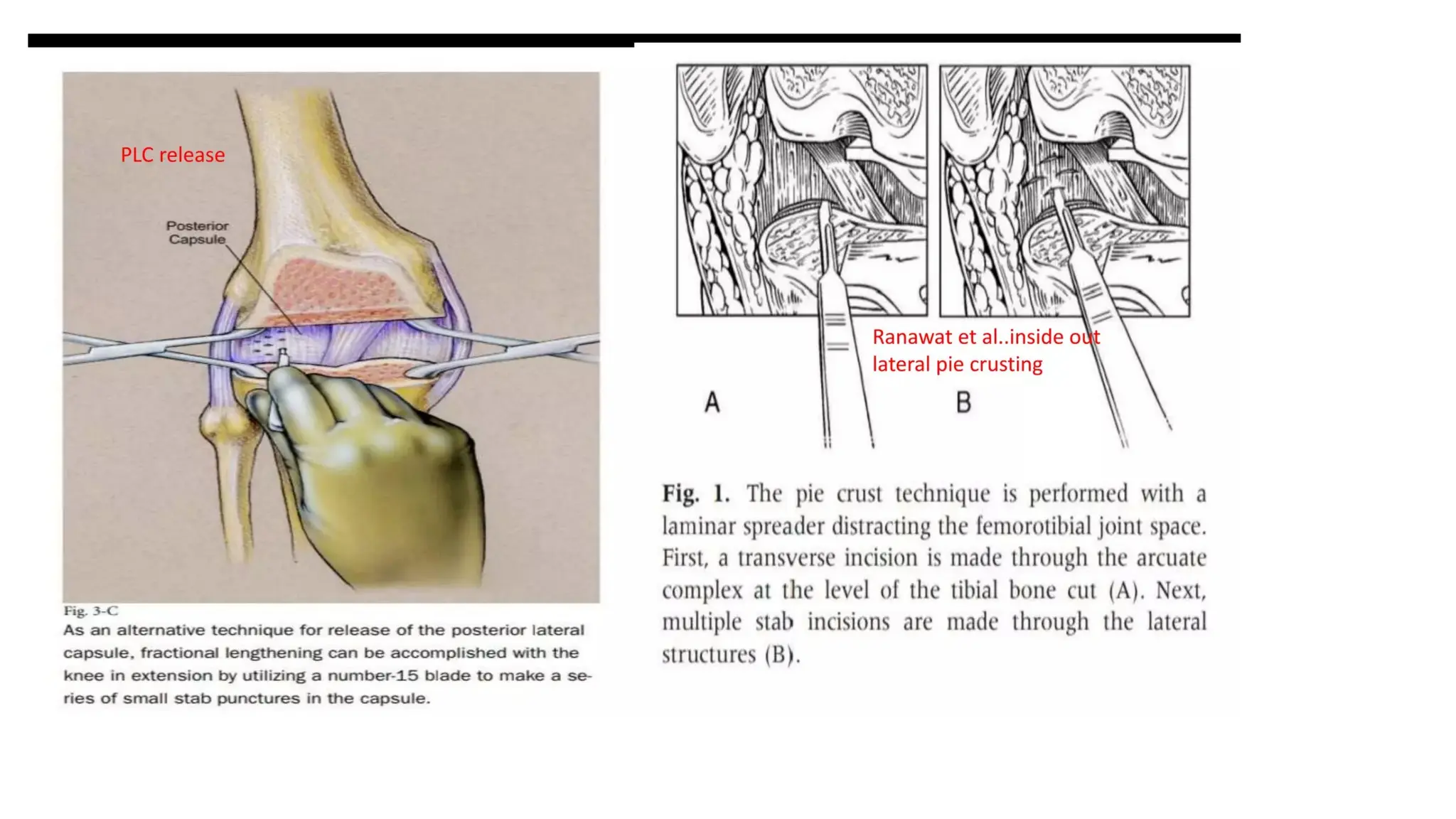 TOTAL KNEE ARTRHOPLASTY IN VALGUS KNEE (1).pptx