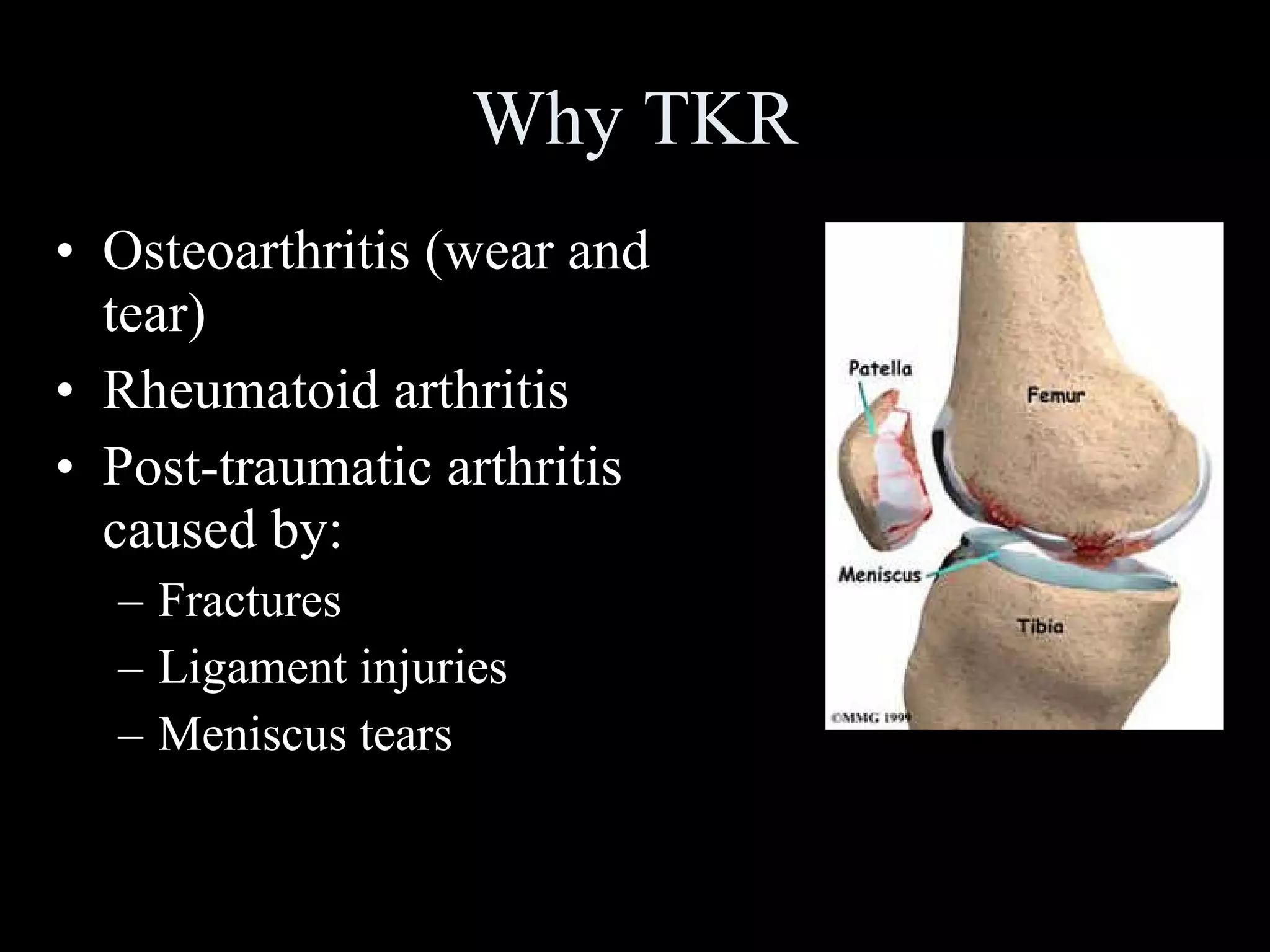 Total Knee Replacement | PPT