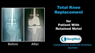 Total knee replacement for patient with retained implant and metal | PPTX