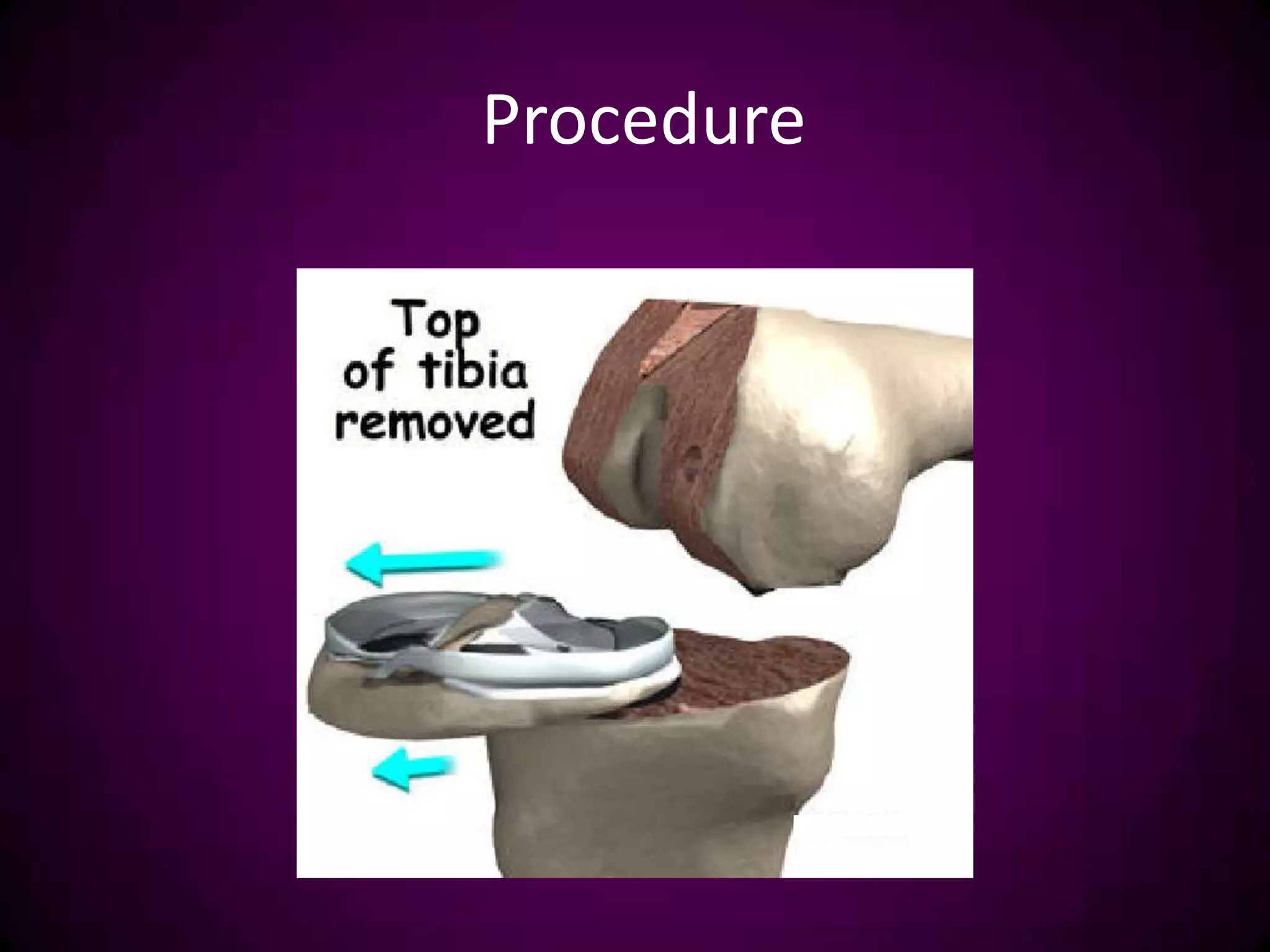 Total knee replacement nursing management | PPTX