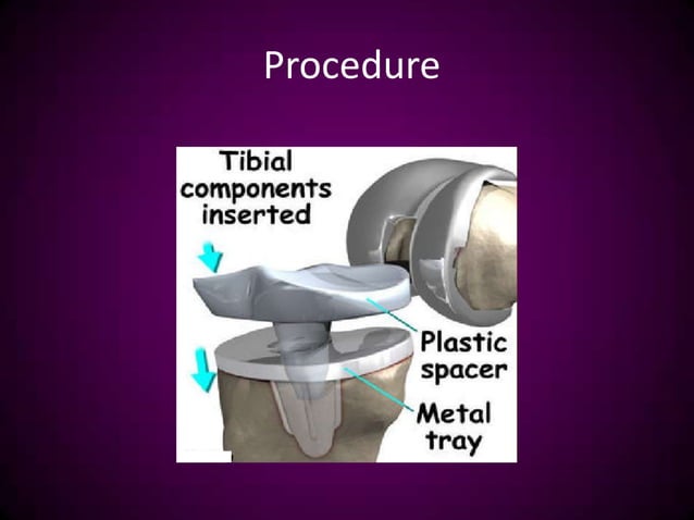 Total knee replacement nursing management | PPTX | Physical Therapy ...
