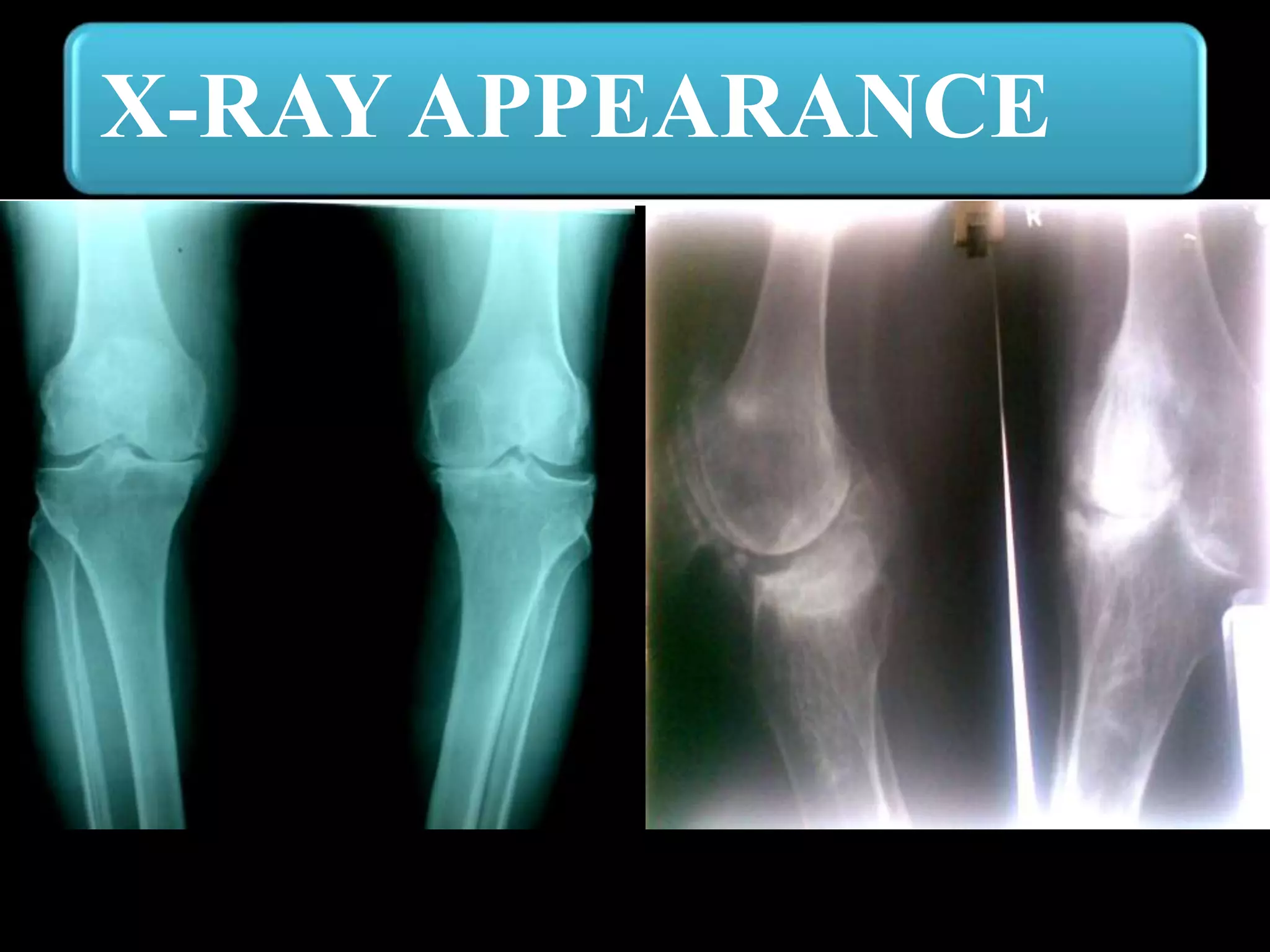 Total knee replacement patient education | PPTX