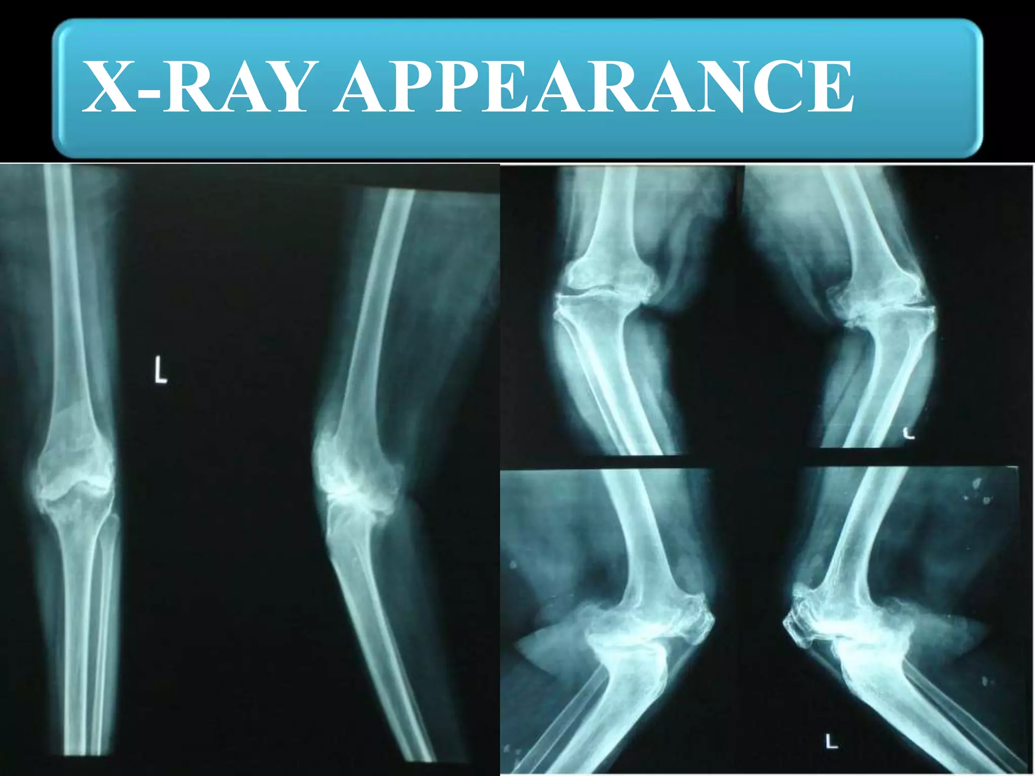 Total knee replacement patient education | PPTX