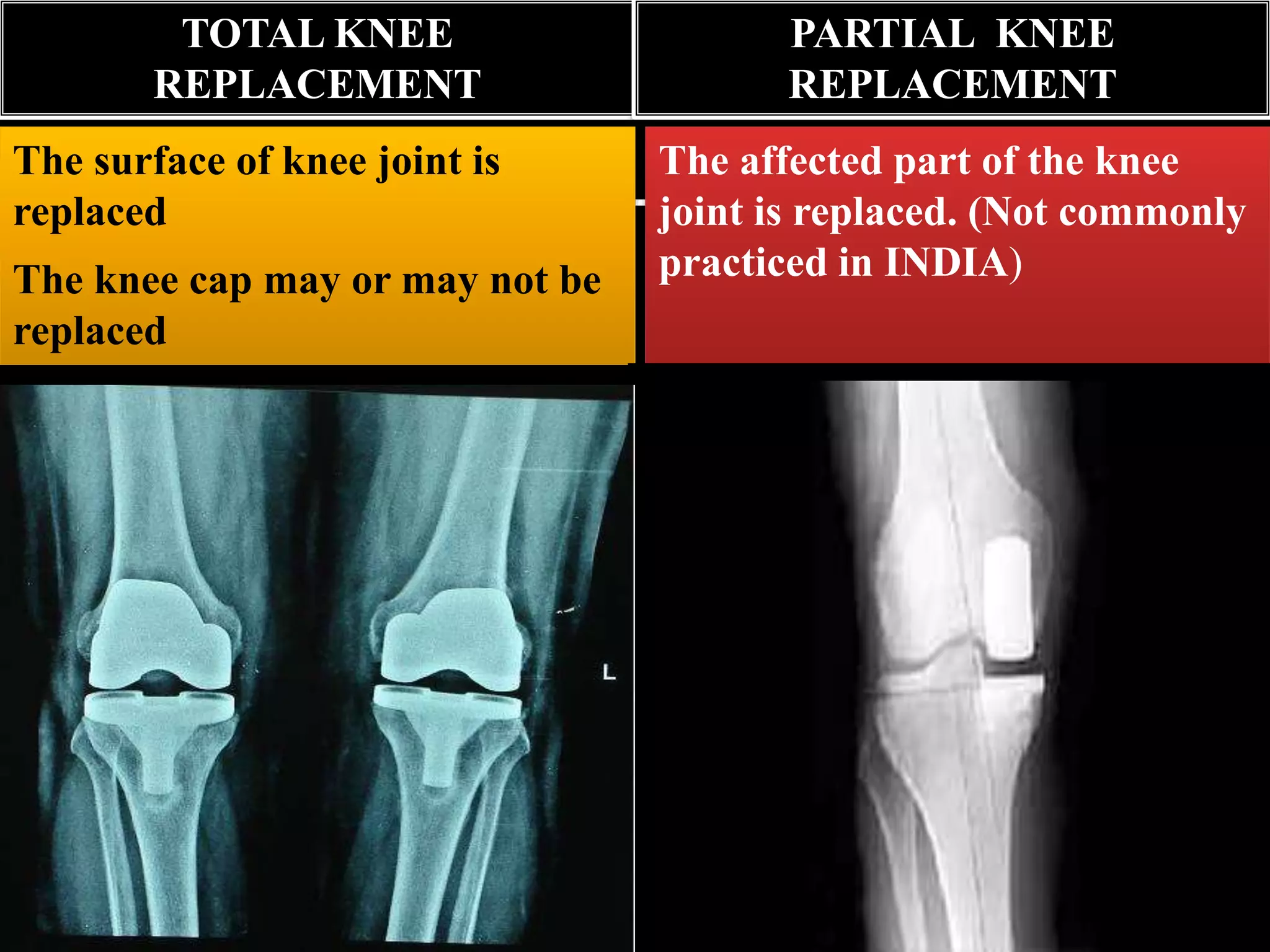 Total knee replacement patient education | PPTX