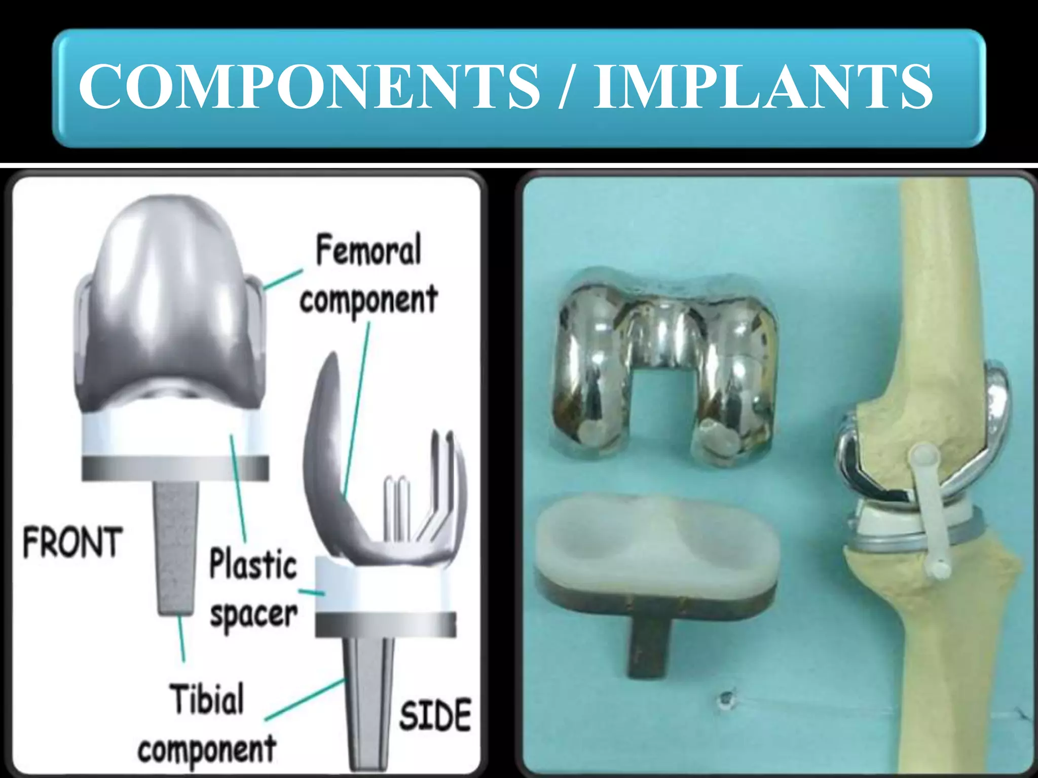Total knee replacement patient education | PPTX
