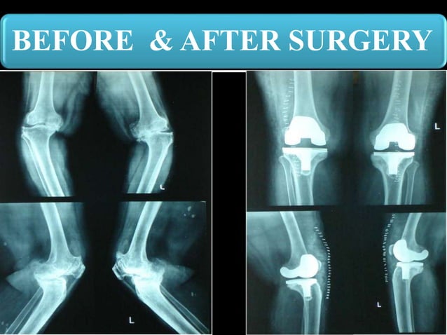 Total knee replacement patient education | PPTX