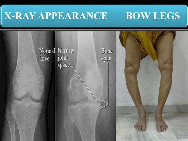 Total knee replacement patient education | PPTX