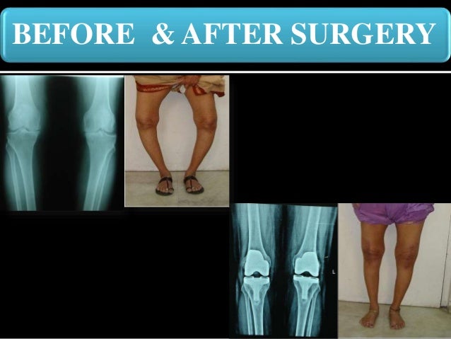 Total knee replacement patient education