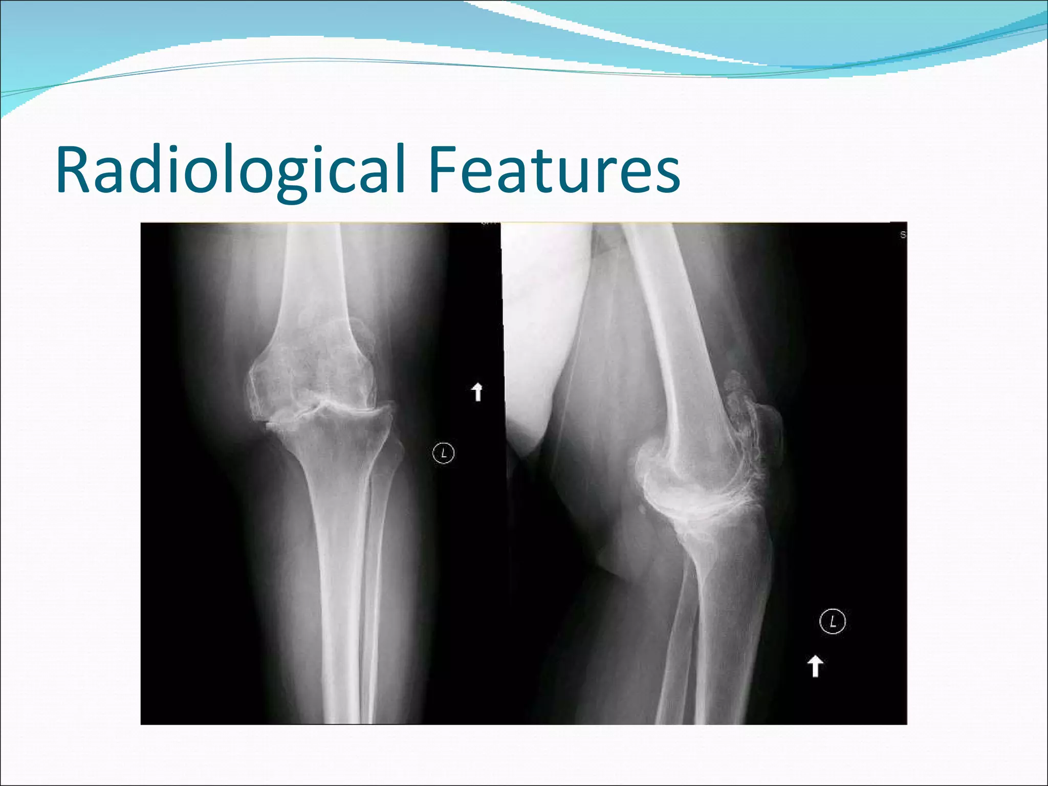 Total knee replacement (tkr) ppt | PPT
