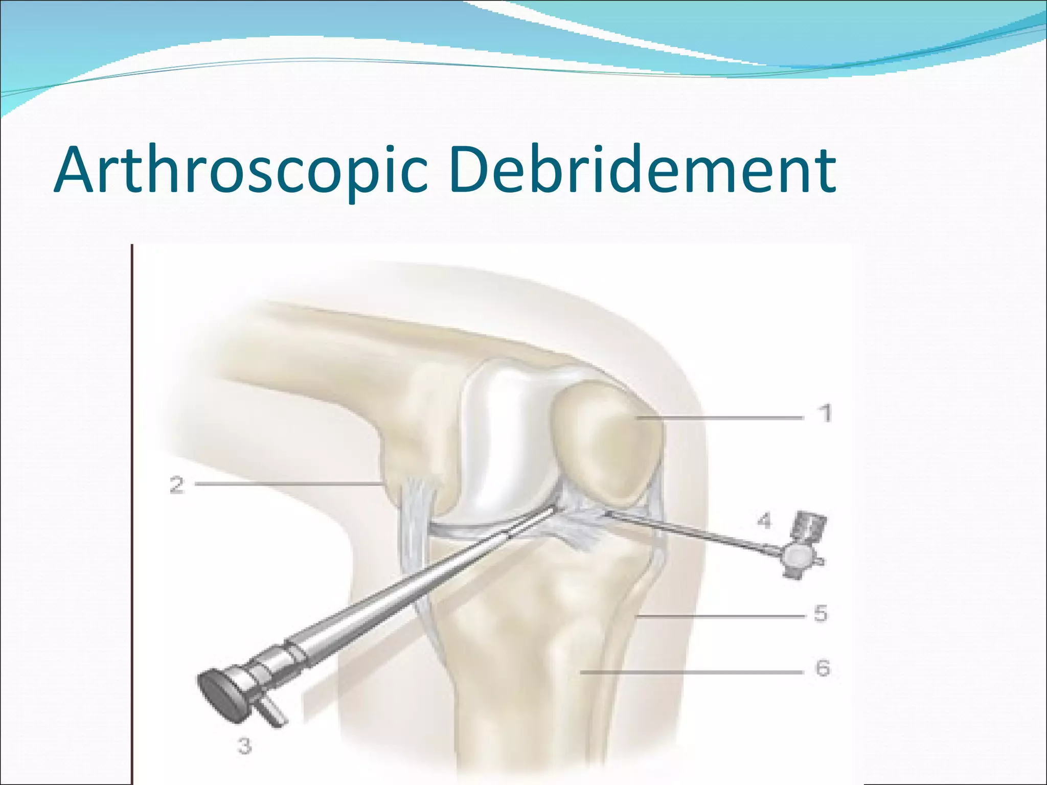Total knee replacement (tkr) ppt | PPT