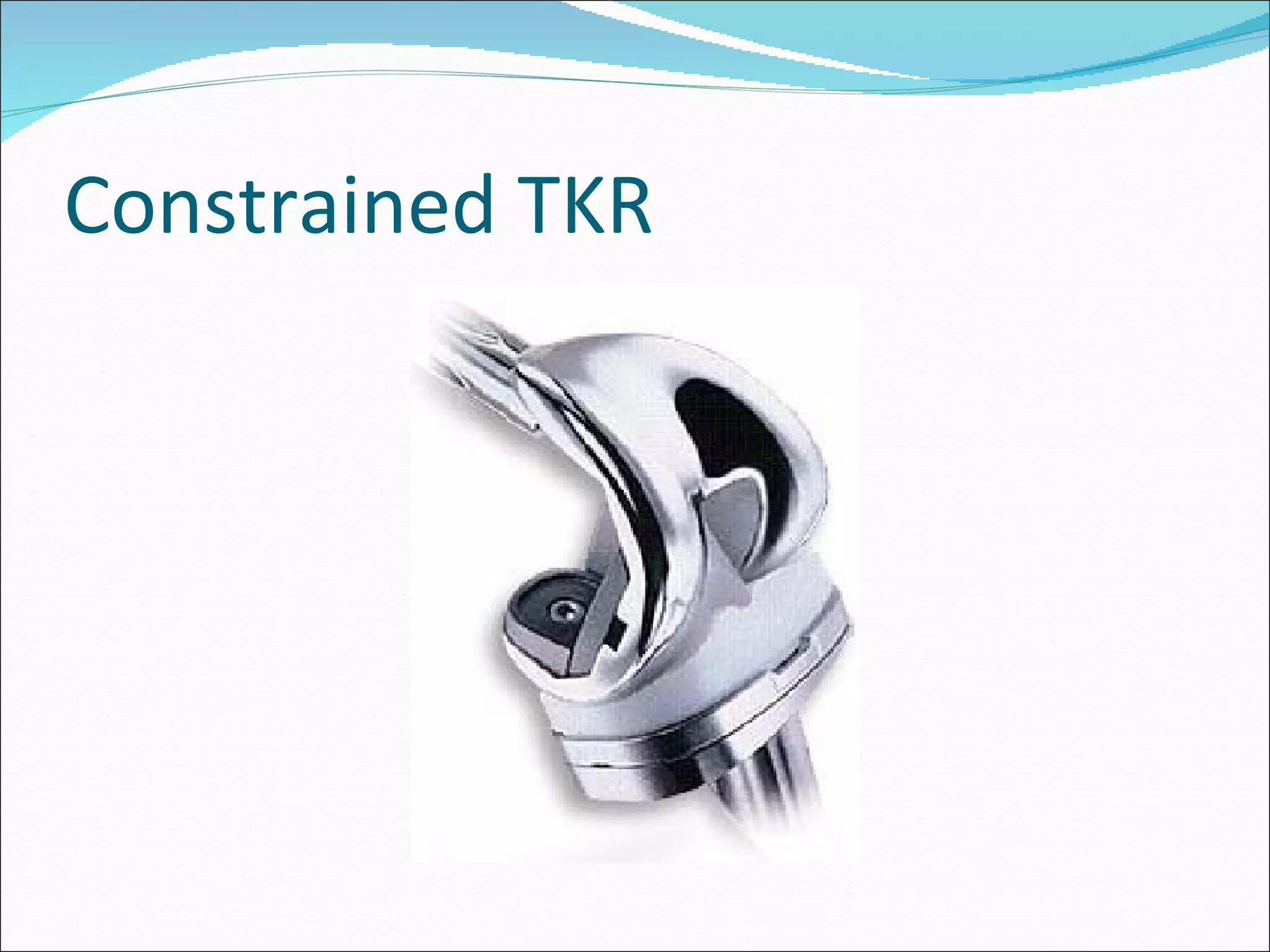 Total knee replacement (tkr) ppt | PPT
