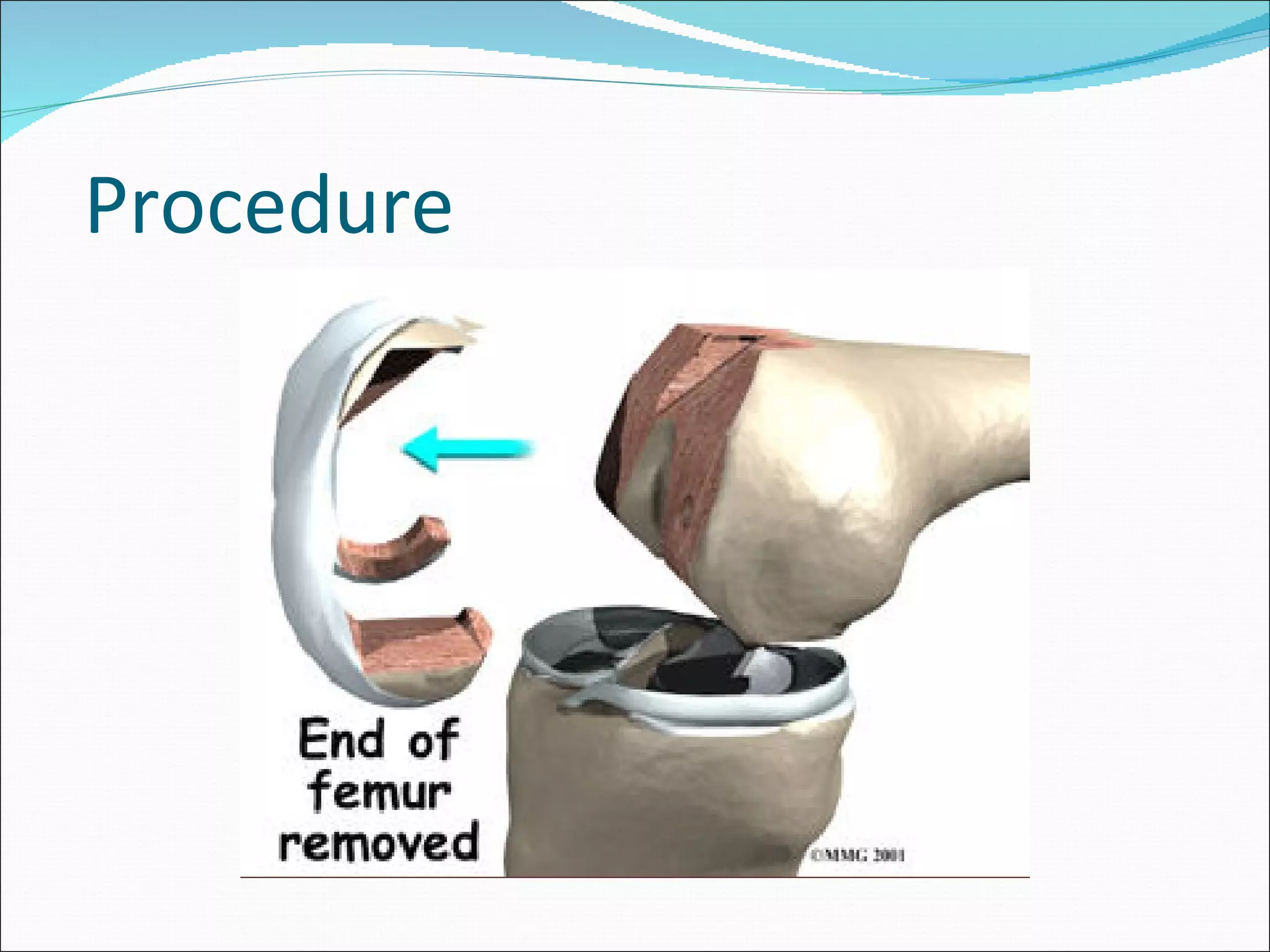 Total knee replacement (tkr) ppt | PPT