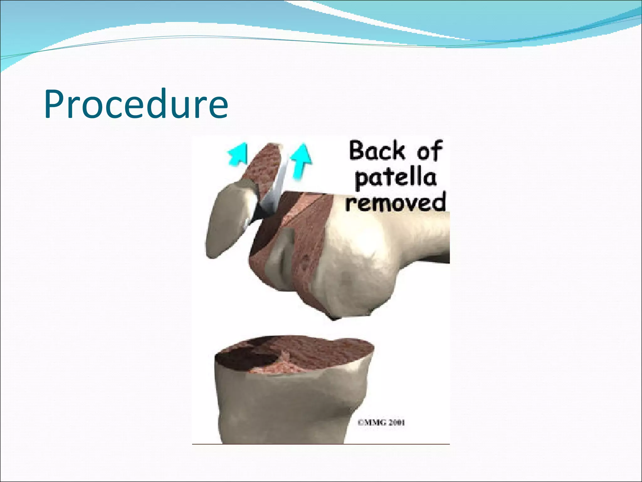 Total knee replacement (tkr) ppt | PPT