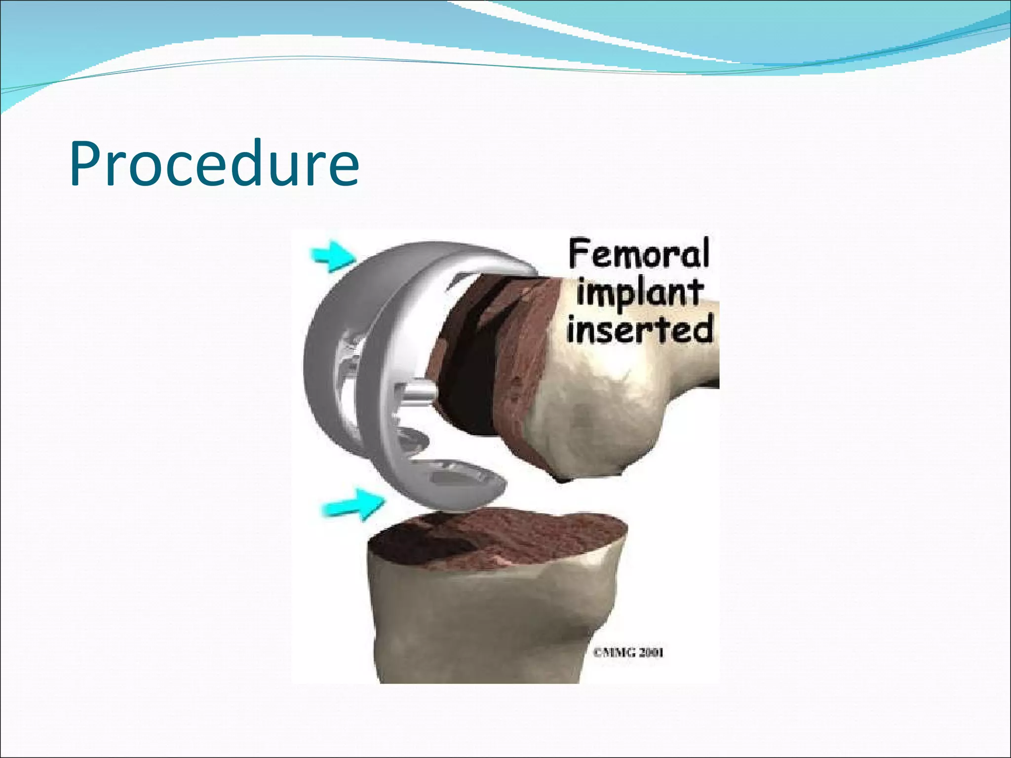 Total knee replacement (tkr) ppt | PPT