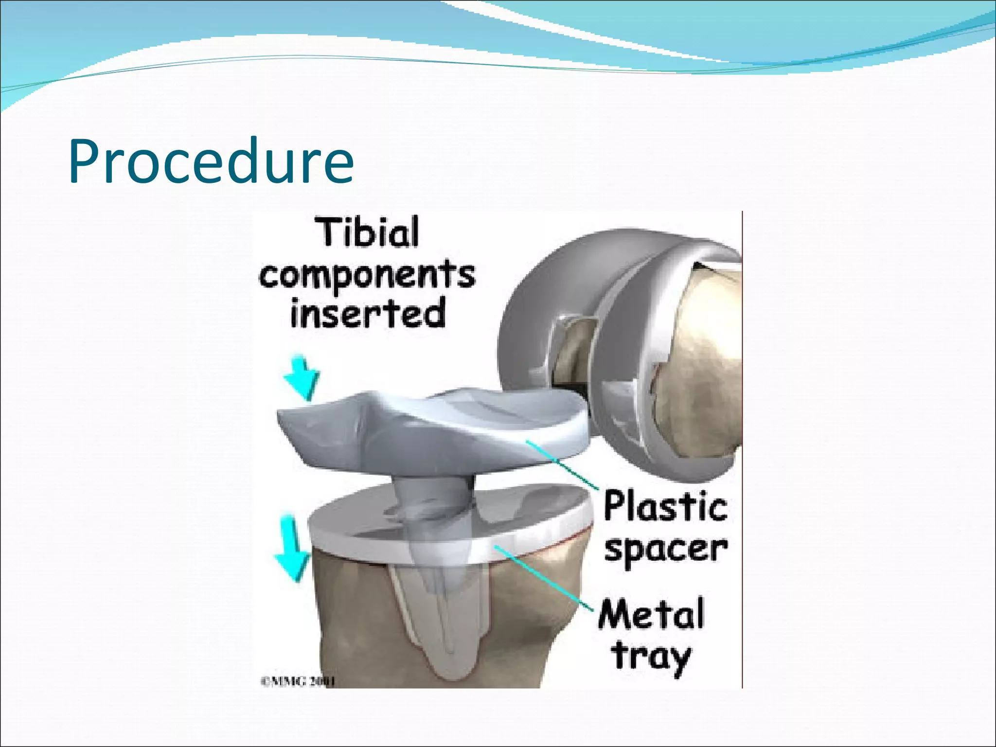 Total knee replacement (tkr) ppt | PPT