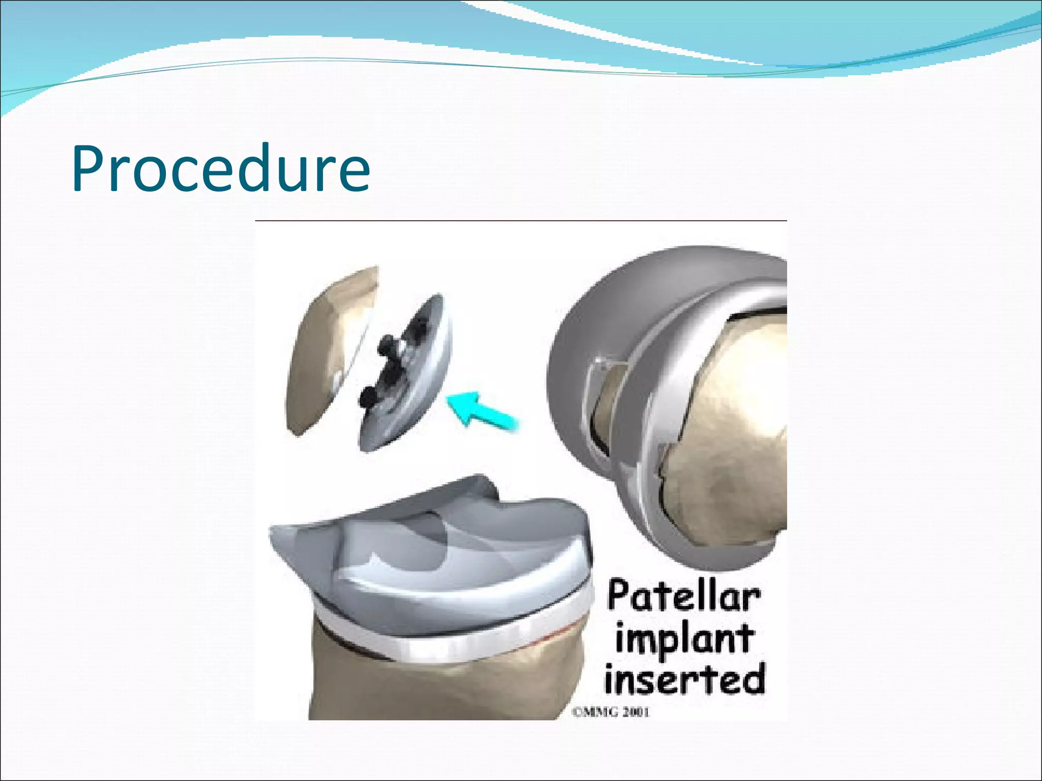 Total knee replacement (tkr) ppt | PPT
