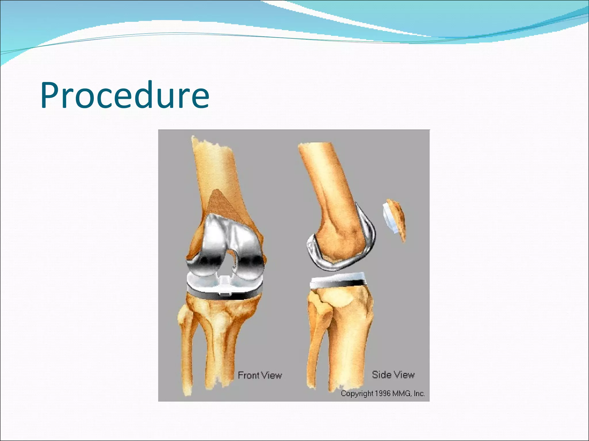 Total knee replacement (tkr) ppt | PPT