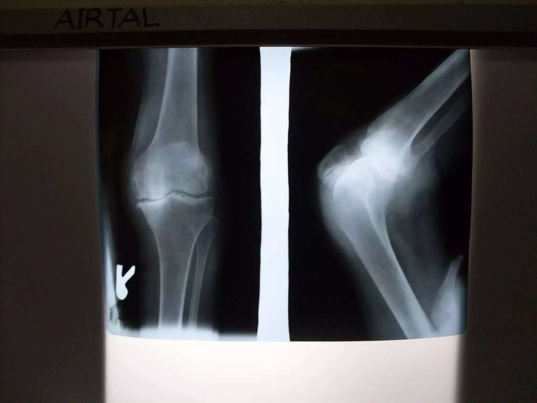 Total knee replacement (tkr) ppt | PPT