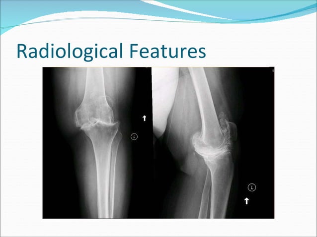 Total knee replacement (tkr) ppt | PPT