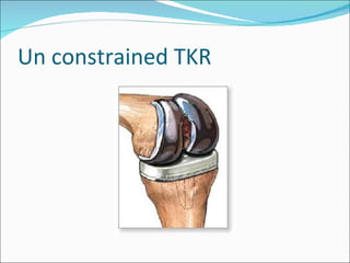 Total knee replacement (tkr) ppt | PPT