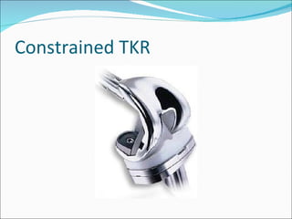 Total knee replacement (tkr) ppt | PPT
