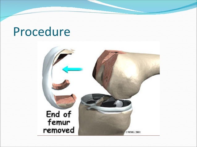 Total knee replacement (tkr) ppt | PPT