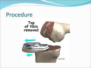 Total knee replacement (tkr) ppt | PPT