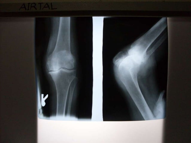 Total knee replacement (tkr) ppt | PPT