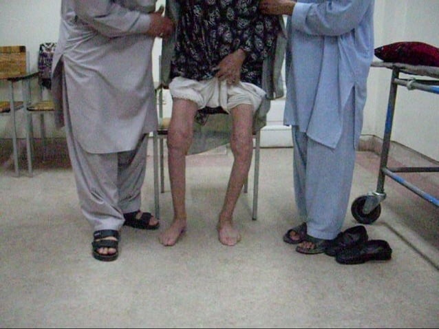 Total knee replacement (tkr) ppt | PPT