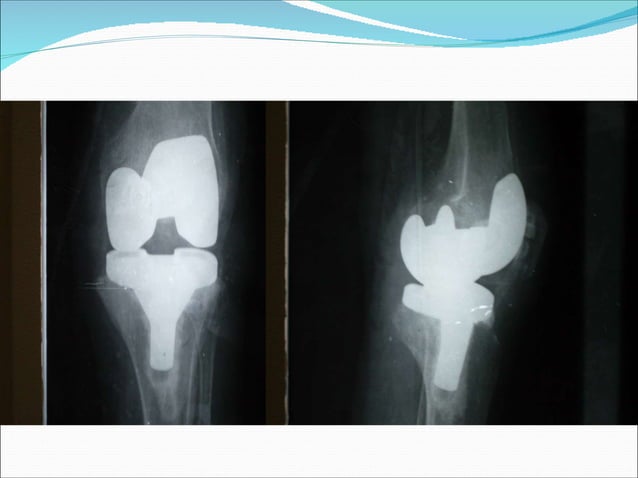 Total knee replacement (tkr) ppt | PPT